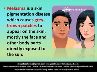 Melasma| Melasma and its Treatment| Facial Pigmentation| Post-Pregnancy ...