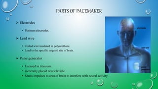 BRAIN PACE MAKER | PPTX