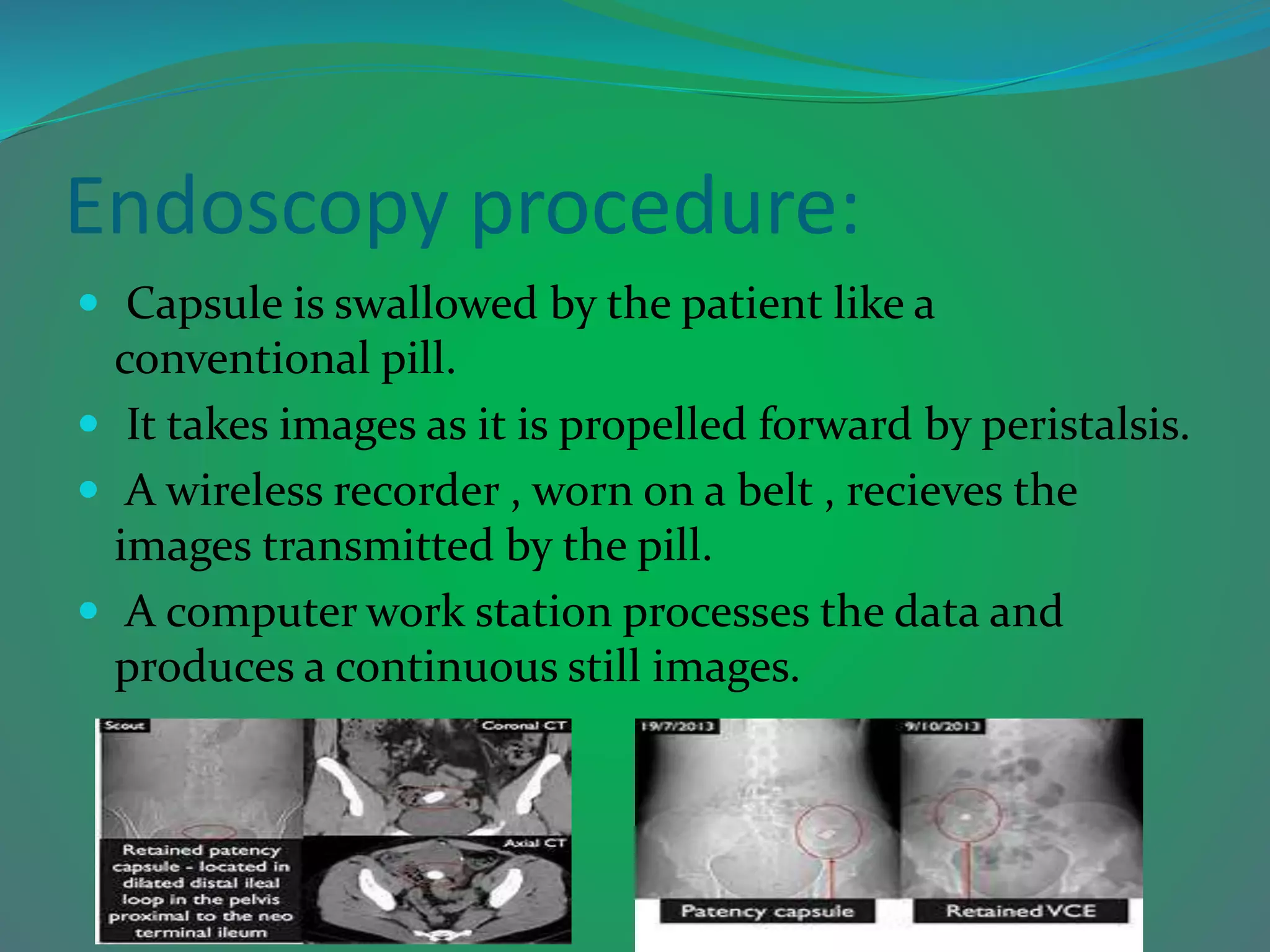 CAPSULE ENDOSCOPY | PPTX | Digestive Disorders | Diseases and Conditions