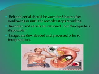 CAPSULE ENDOSCOPY | PPTX
