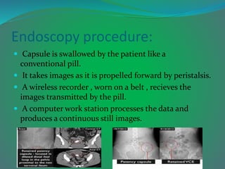 CAPSULE ENDOSCOPY | PPTX | Digestive Disorders | Diseases and Conditions