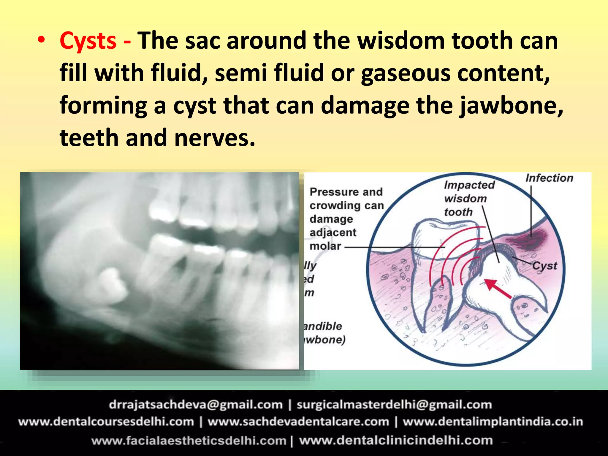Painless Wisdom Tooth Removal| Impaction of Third Molar| Piezo and ...