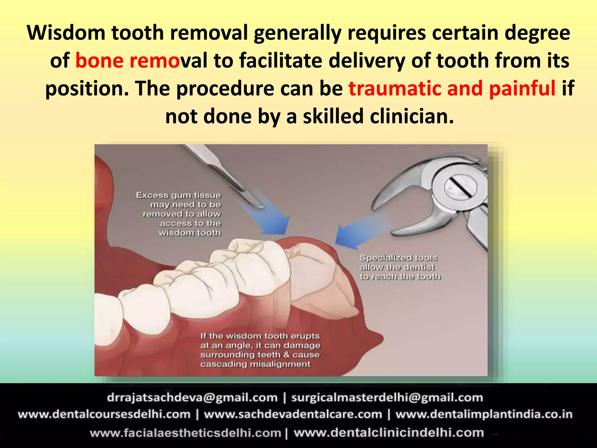 Painless Wisdom Tooth Removal| Impaction of Third Molar| Piezo and ...