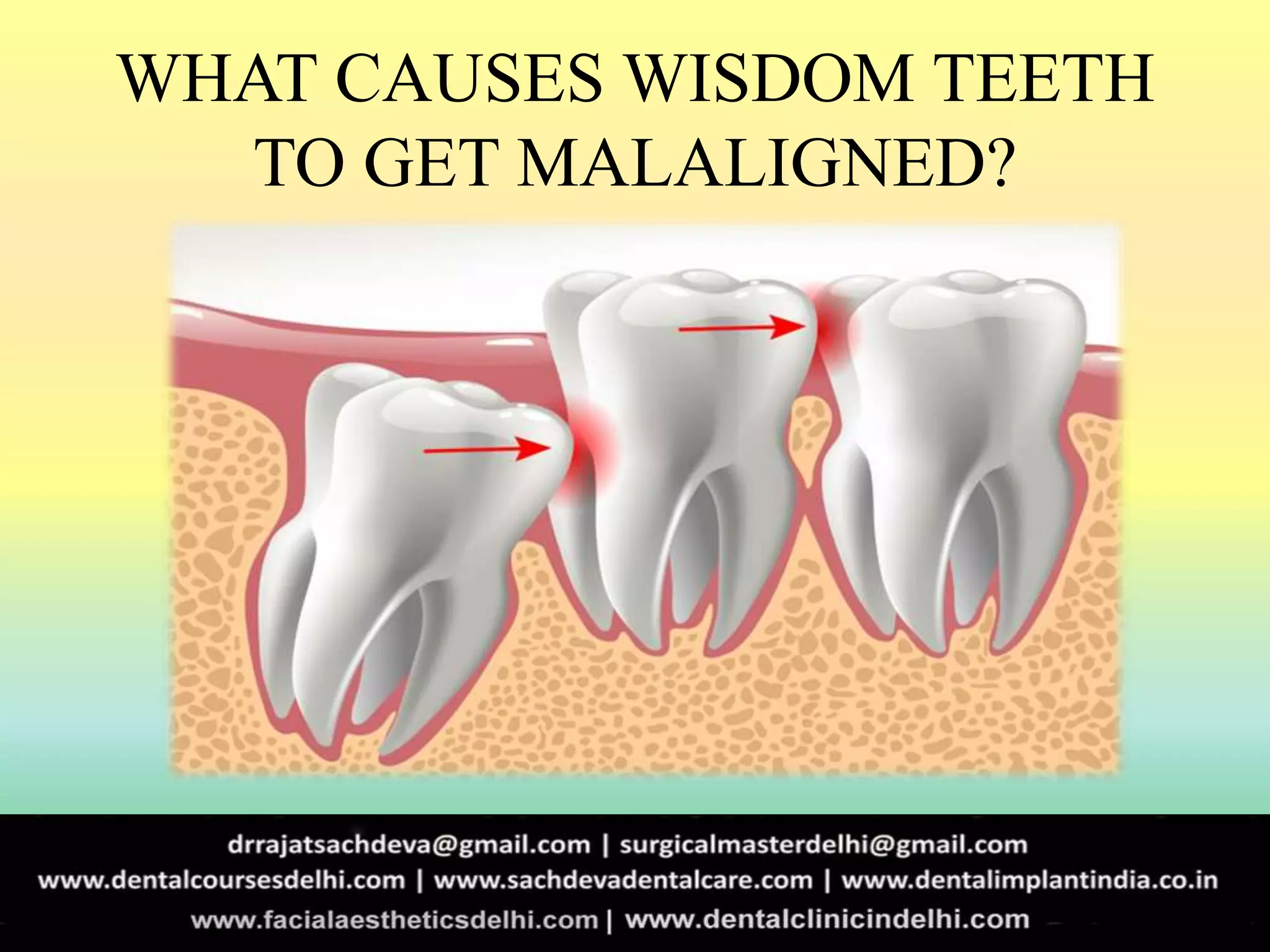 Painless Wisdom Tooth Removal| Impaction of Third Molar| Piezo and ...