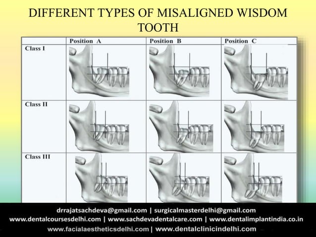 Painless Wisdom Tooth Removal| Impaction of Third Molar| Piezo and ...