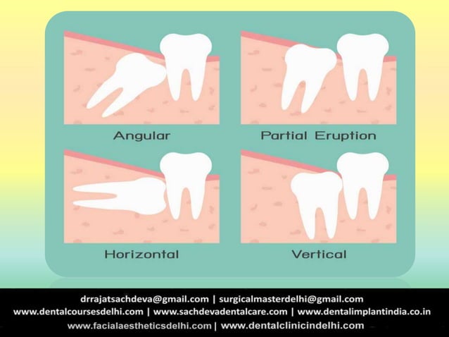 Painless Wisdom Tooth Removal| Impaction of Third Molar| Piezo and ...