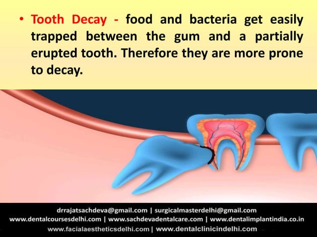 Painless Wisdom Tooth Removal| Impaction of Third Molar| Piezo and ...
