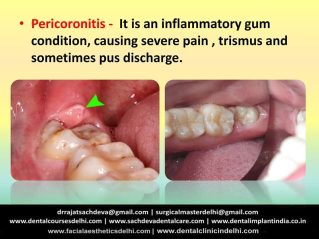 Painless Wisdom Tooth Removal| Impaction of Third Molar| Piezo and ...