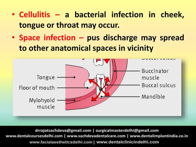 Painless Wisdom Tooth Removal| Impaction of Third Molar| Piezo and ...