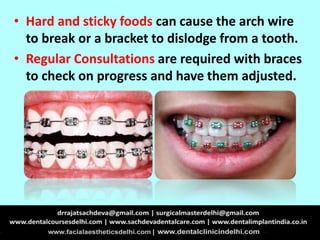 Invisalign| Clear Braces| Invisalign V/s Braces | PPTX