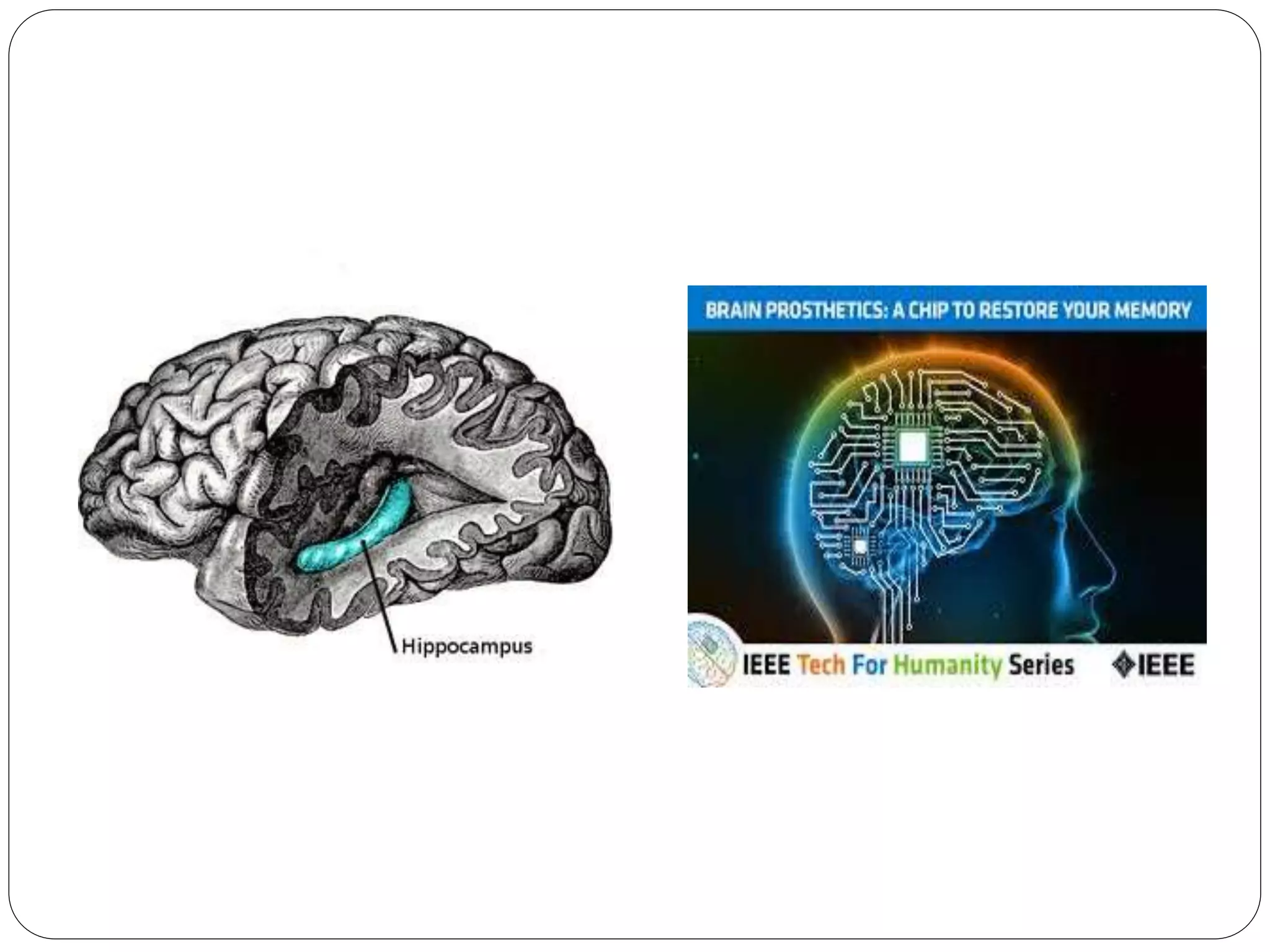 BRAIN PROSTHETICS | PPT