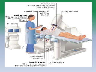 LITHOTRIPSY | PPTX