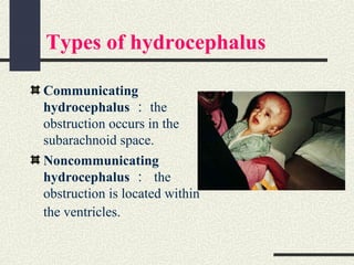 Hydrocephalus | PPT | Brain and Nervous System Disorders | Diseases and ...
