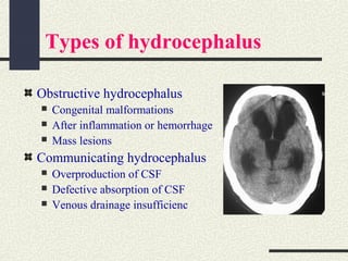 Hydrocephalus | PPT