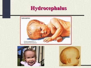 Hydrocephalus | PPT