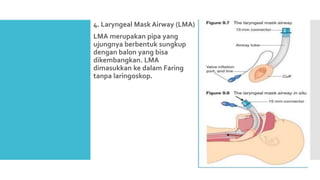 Airway Management | PPTX