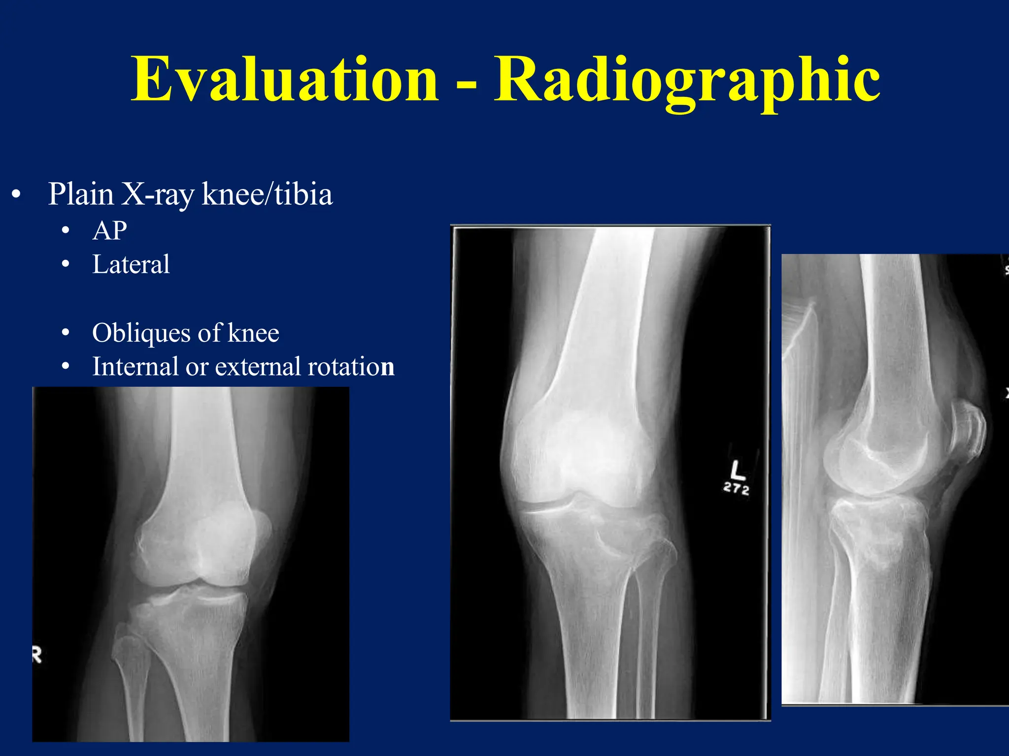 Proximal Tibia Fractures and Its Management.pptx