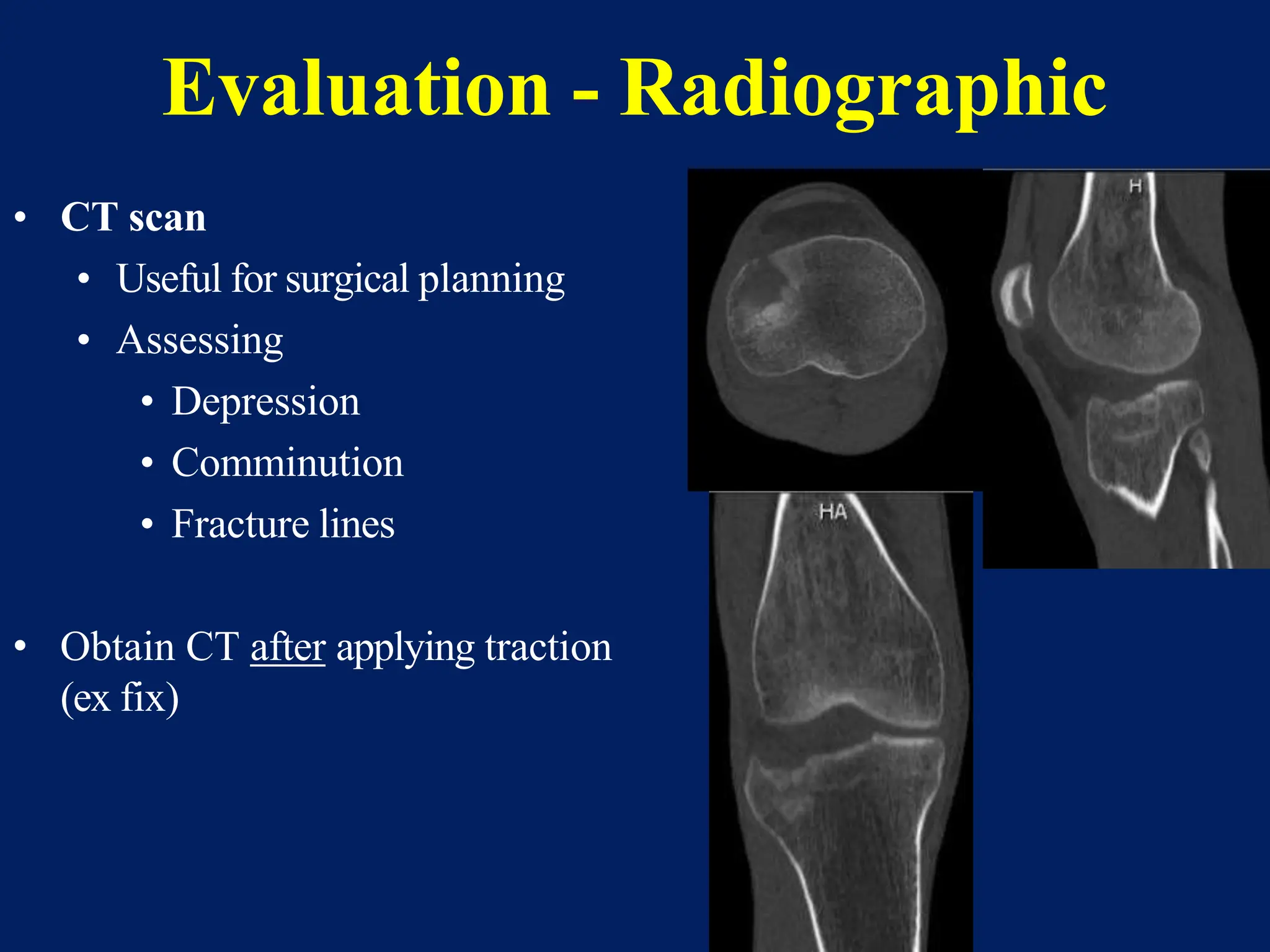 Proximal Tibia Fractures and Its Management.pptx