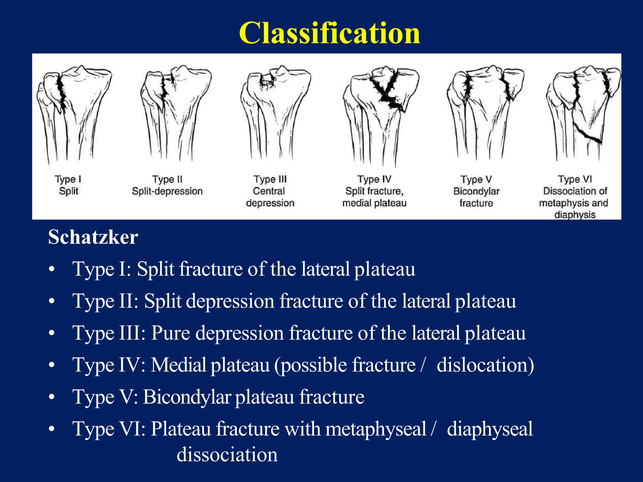 Proximal Tibia Fractures and Its Management.pptx