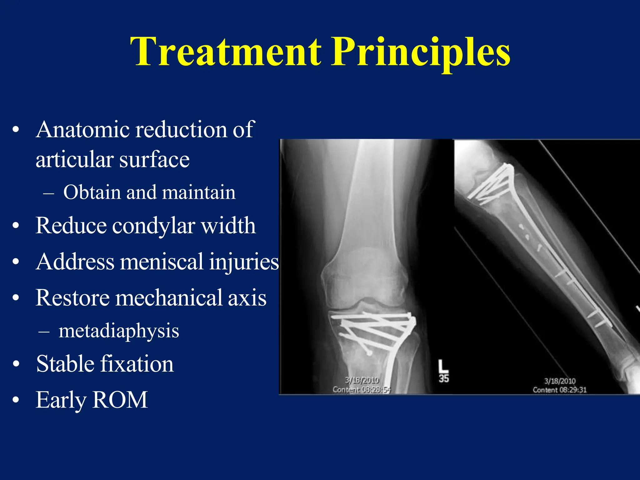 Proximal Tibia Fractures and Its Management.pptx