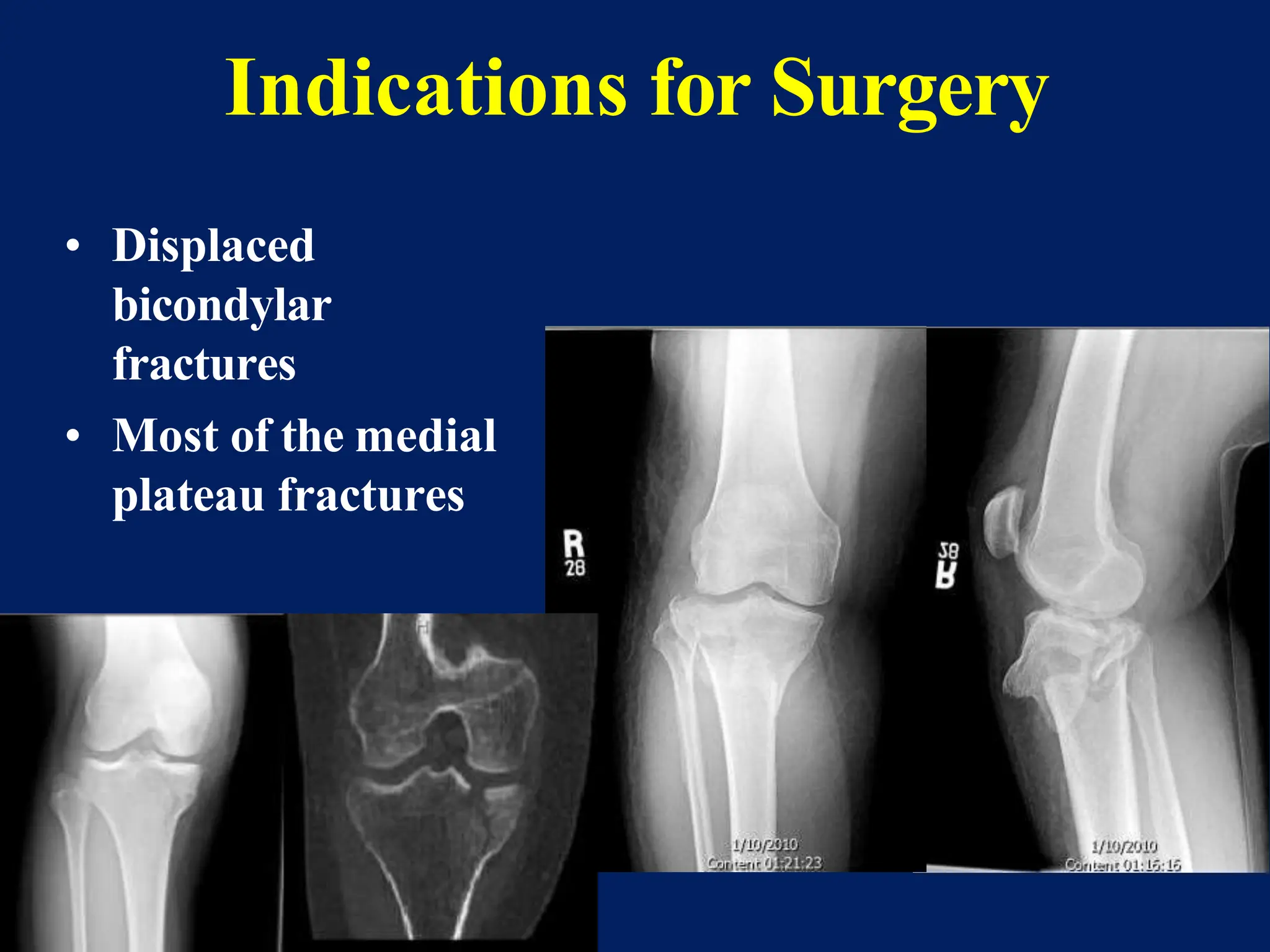 Proximal Tibia Fractures and Its Management.pptx