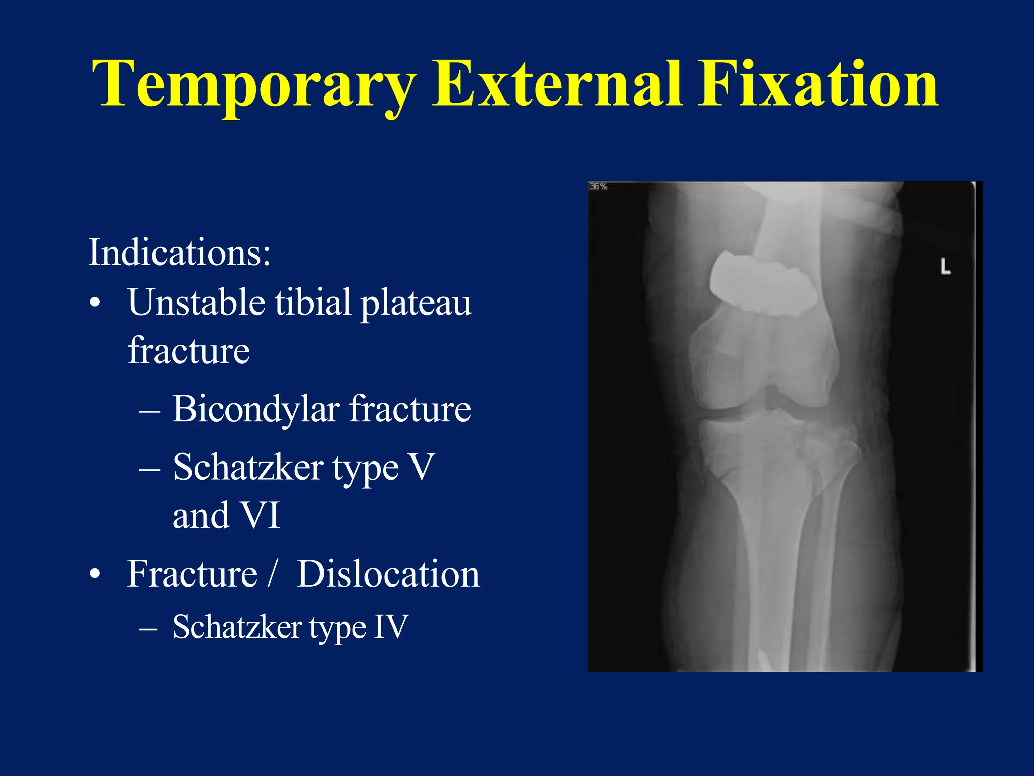 Proximal Tibia Fractures and Its Management.pptx | Free Download