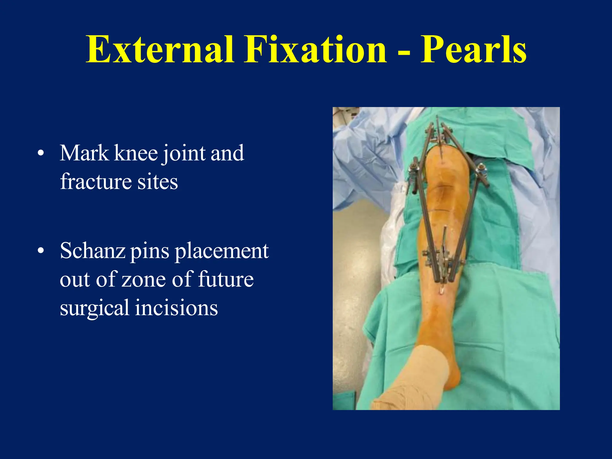 Proximal Tibia Fractures and Its Management.pptx