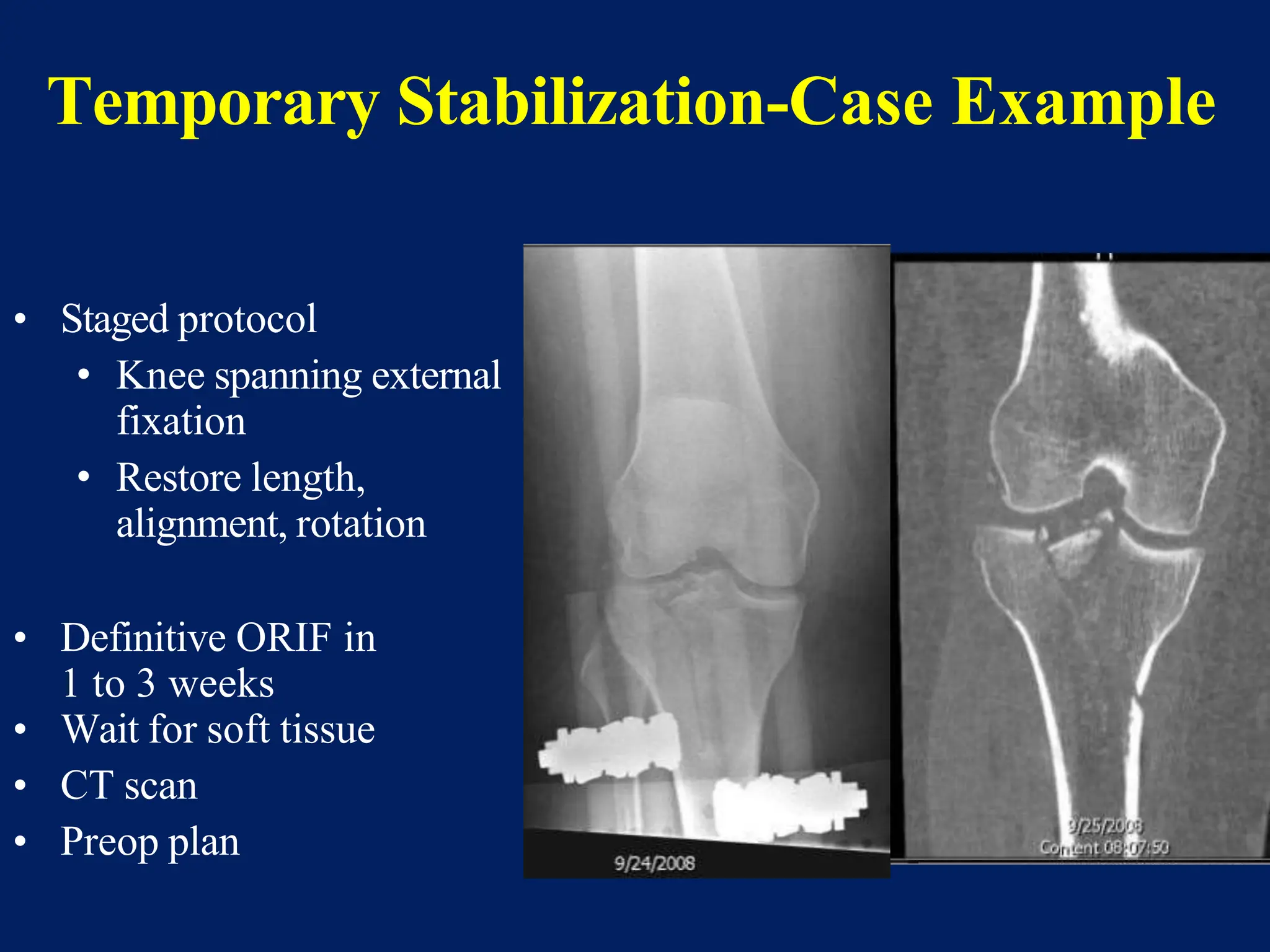 Proximal Tibia Fractures and Its Management.pptx