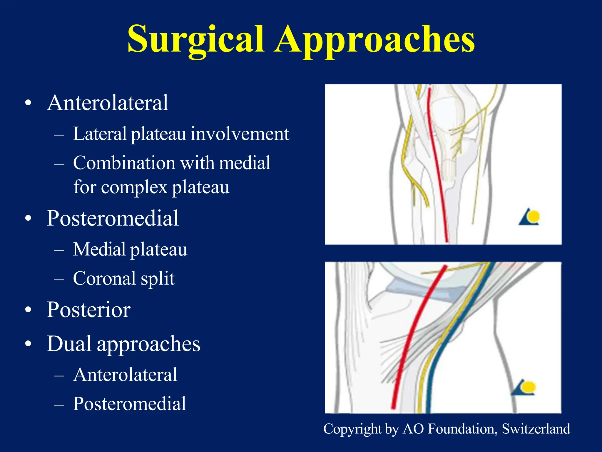 Proximal Tibia Fractures and Its Management.pptx