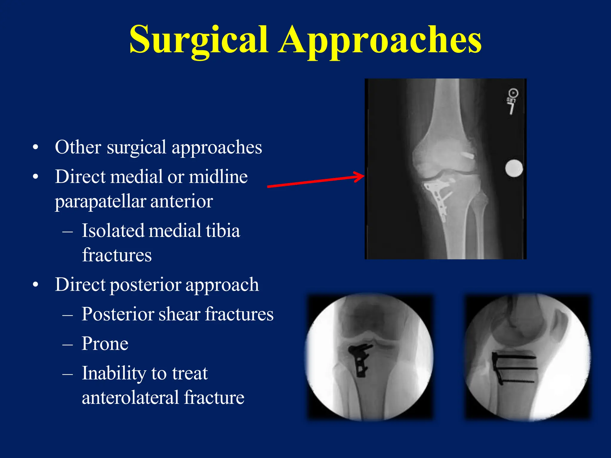 Proximal Tibia Fractures and Its Management.pptx