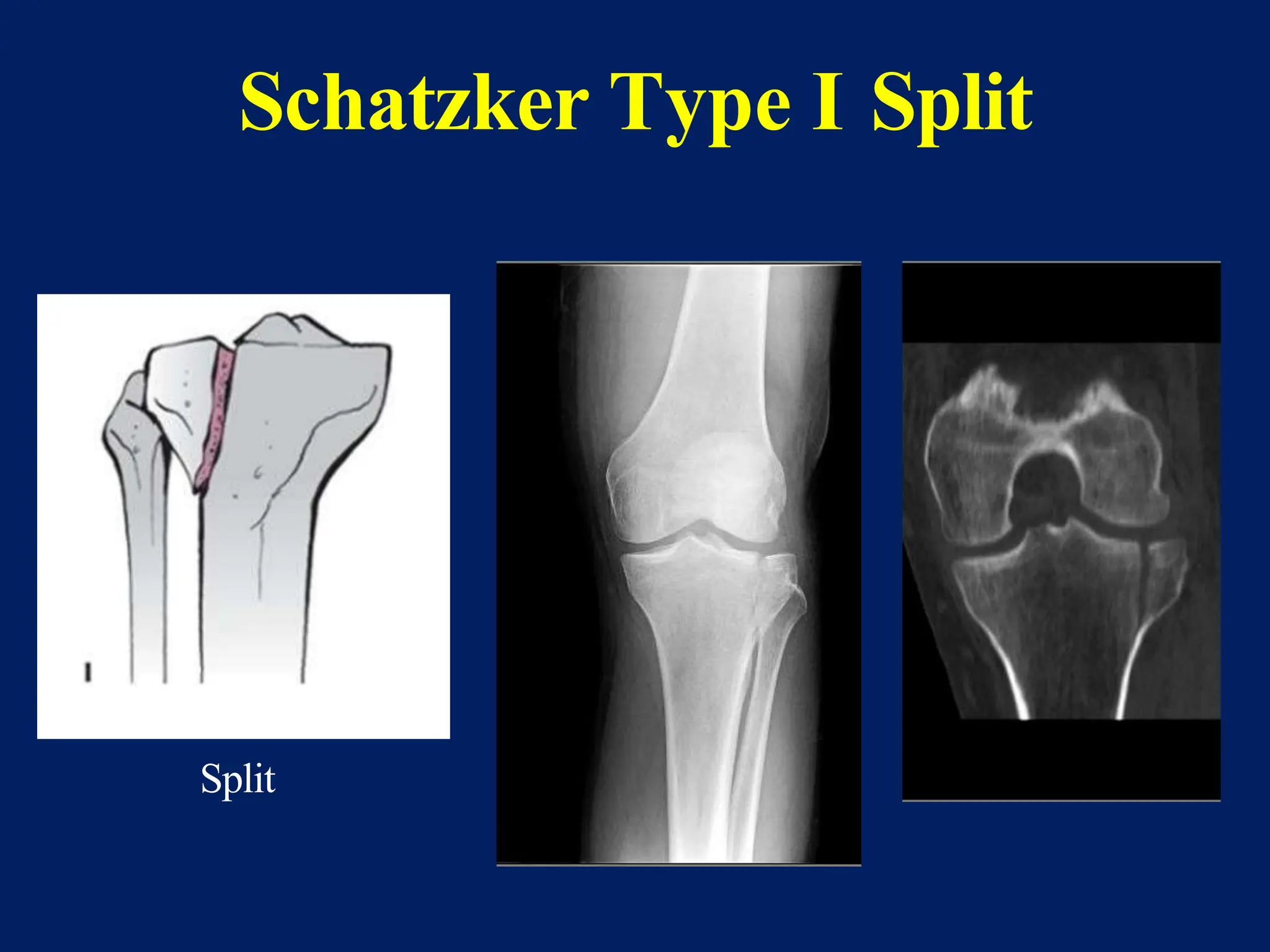 Proximal Tibia Fractures And Its Management Pptx
