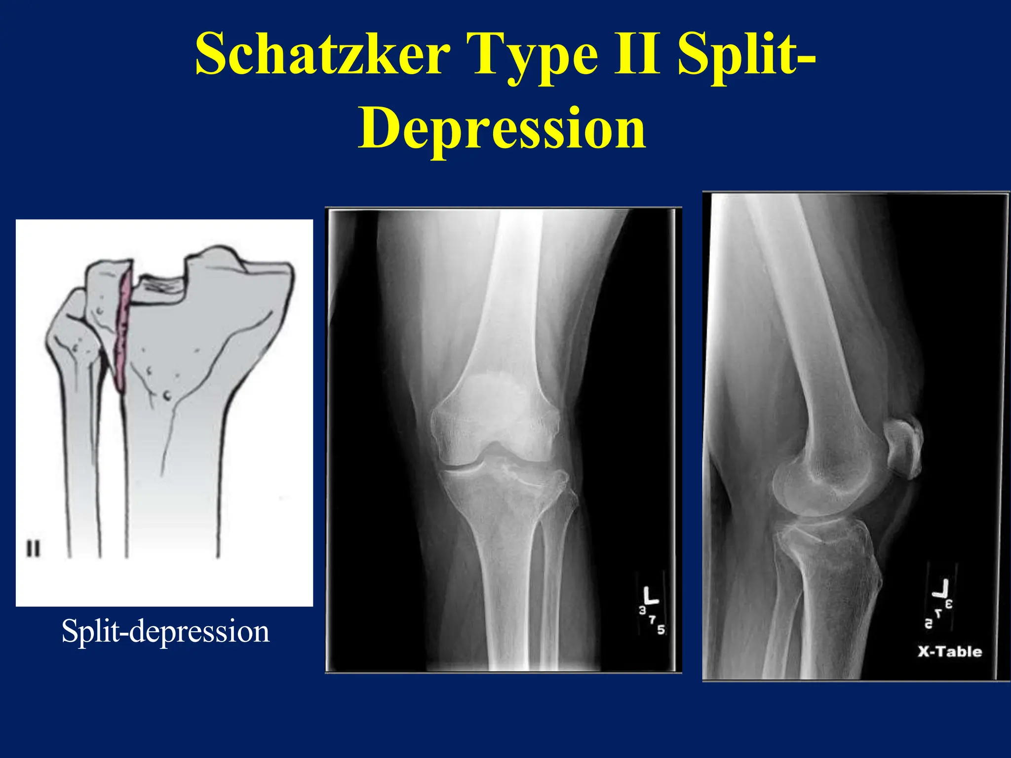 Proximal Tibia Fractures and Its Management.pptx