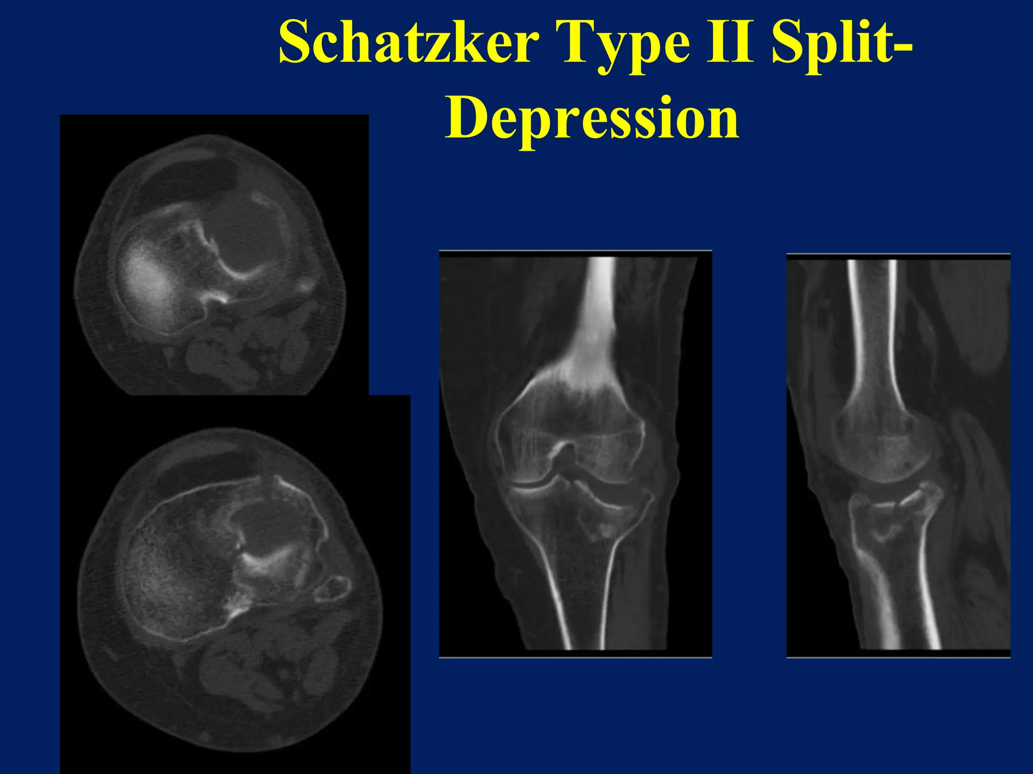 Proximal Tibia Fractures and Its Management.pptx