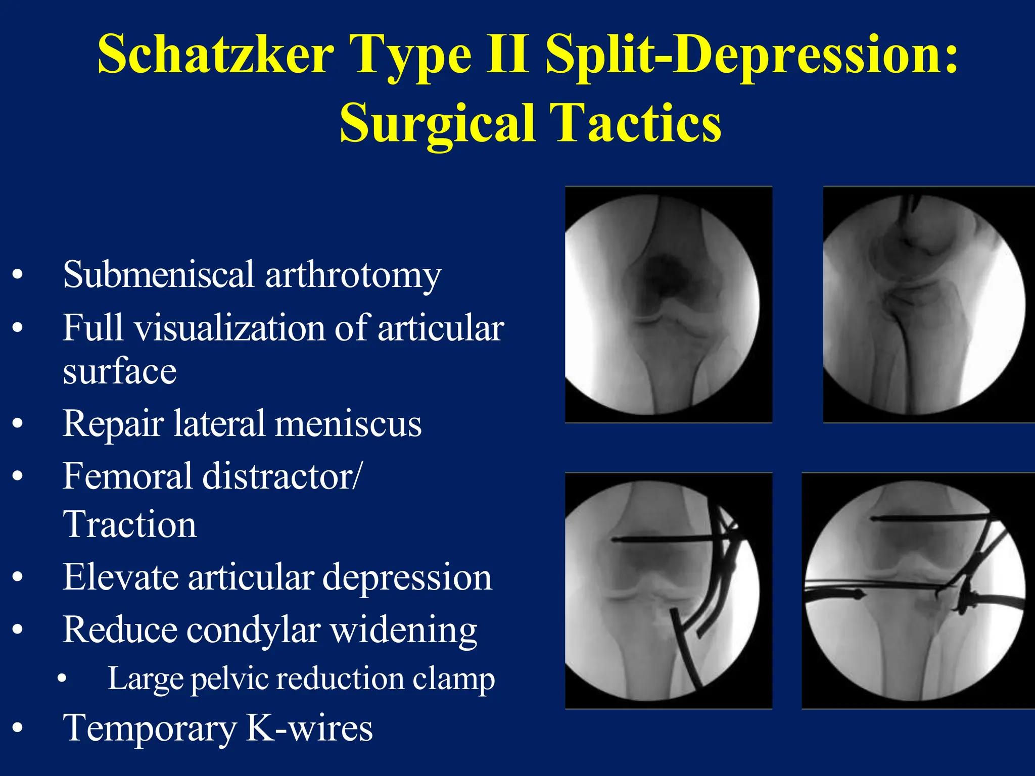 Proximal Tibia Fractures And Its Management Pptx