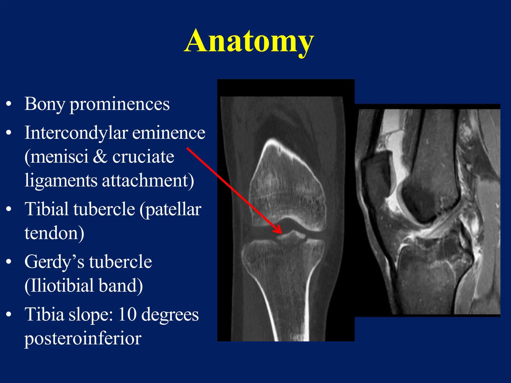 Proximal Tibia Fractures and Its Management.pptx