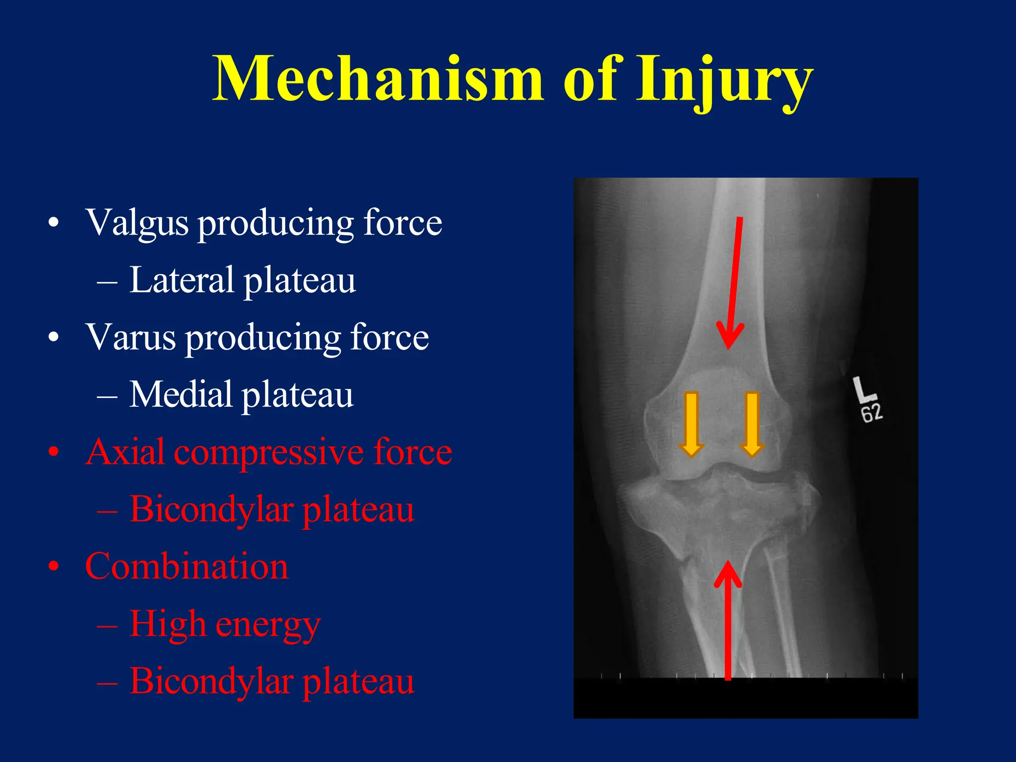 Proximal Tibia Fractures and Its Management.pptx