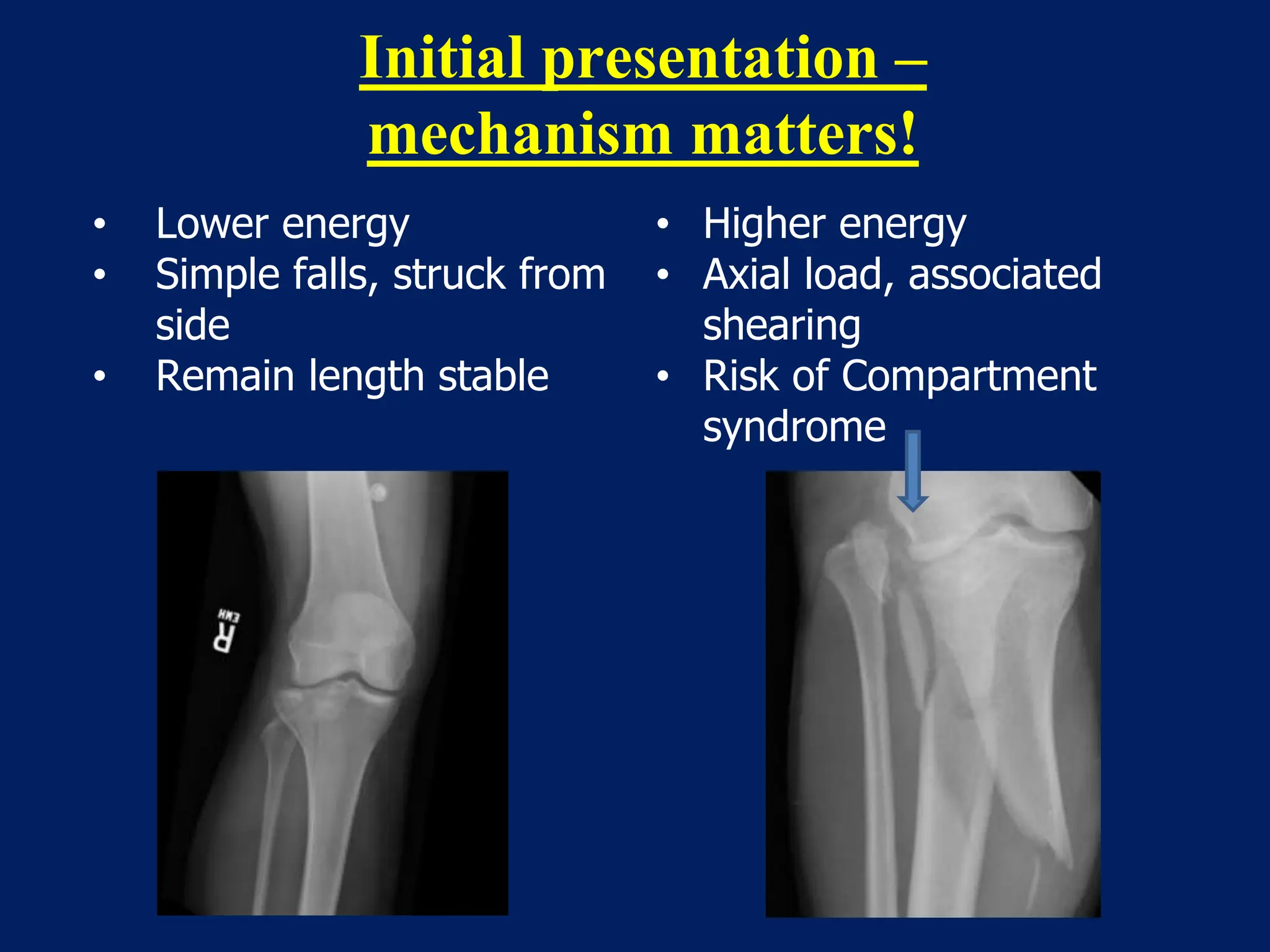 Proximal Tibia Fractures and Its Management.pptx