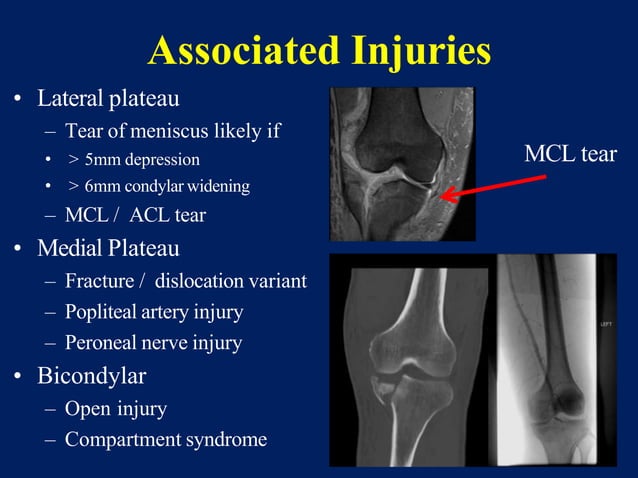 Proximal Tibia Fractures and Its Management.pptx