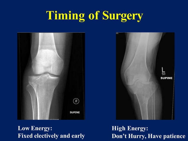 Proximal Tibia Fractures and Its Management.pptx
