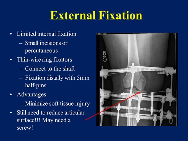 Proximal Tibia Fractures and Its Management.pptx