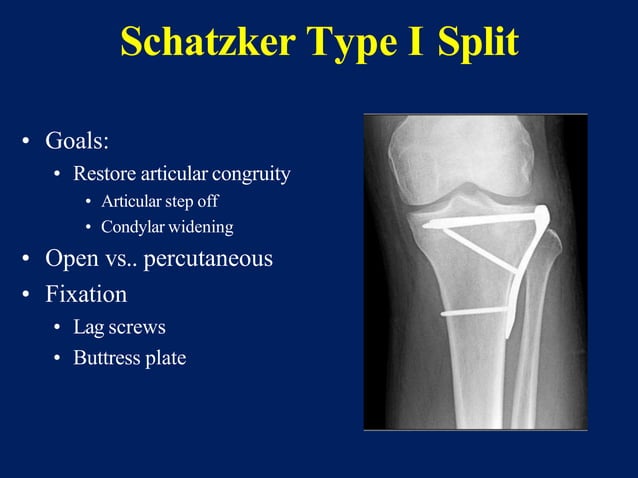 Proximal Tibia Fractures and Its Management.pptx