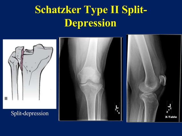 Proximal Tibia Fractures and Its Management.pptx