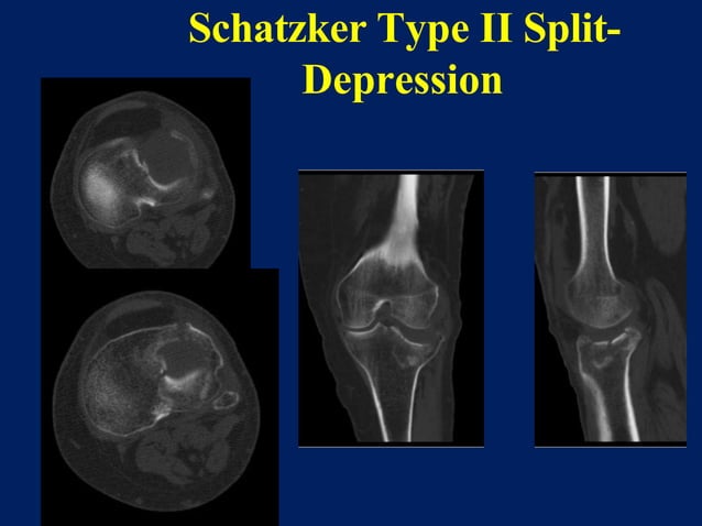 Proximal Tibia Fractures And Its Management Pptx