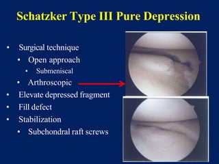 Proximal Tibia Fractures and Its Management.pptx