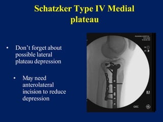 Proximal Tibia Fractures and Its Management.pptx