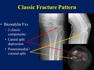 Proximal Tibia Fractures and Its Management.pptx