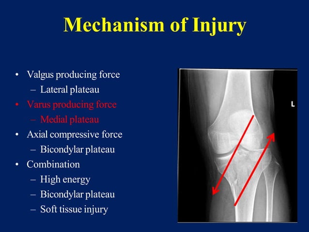 Proximal Tibia Fractures And Its Management Pptx