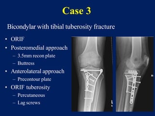 Proximal Tibia Fractures and Its Management.pptx