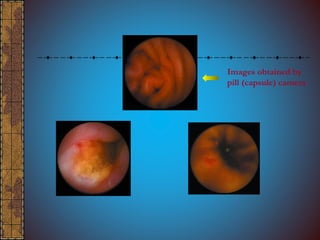 BIOMEDICAL INSTRUMENTATION PILL CAMERA | PPT