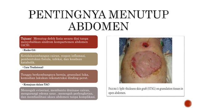 ppt abdominal wall closure indo fix oke.pptx